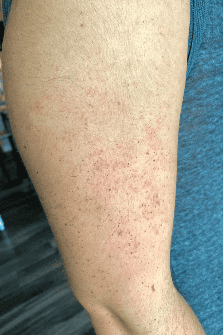 The Best Keratosis Pilaris Moisturizer That Will Leave Your Skin Clear