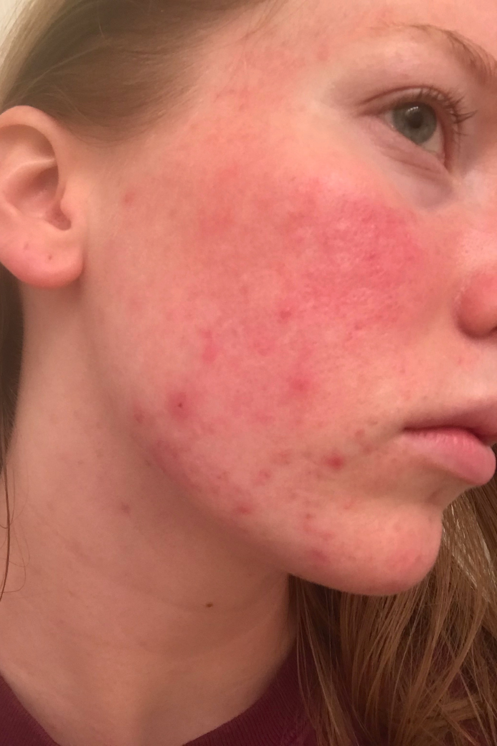 10 Best Acne Remedies To Clear Your Skin For Good - Ash Esthetics